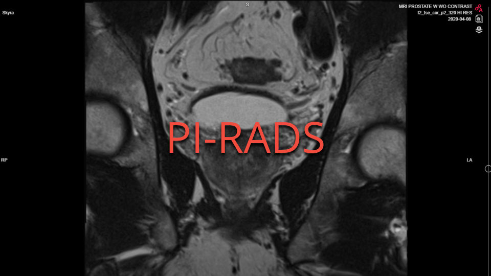 PI-RADS in Research | Standardizing Prostate MRI Trials